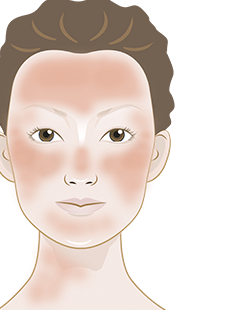 Allergie au soleil : symptômes, traitements et prévention