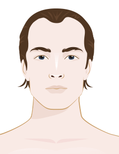 5 étapes pour prévenir une calvitie frontale